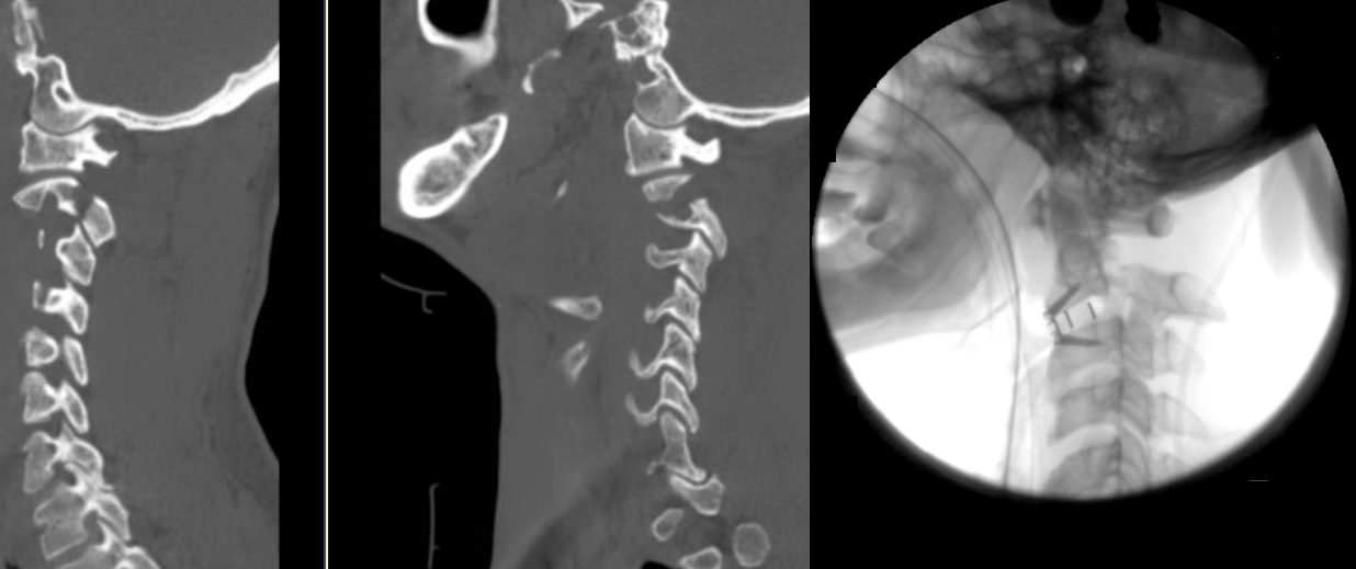 Fracture Surgery – MODERN SPINE